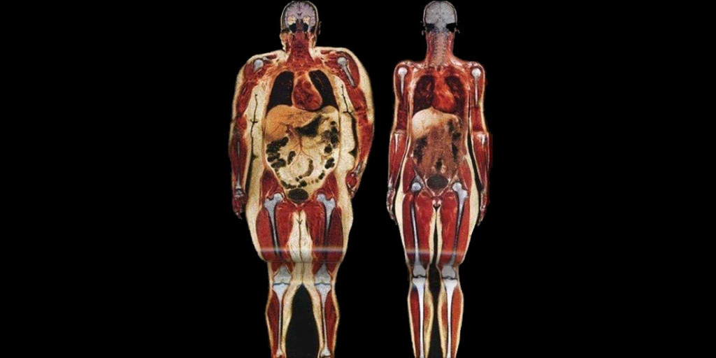 obese-anatomy-comparison | Mexico: Dr Kuri & Associates